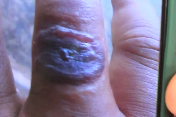 Puluhan warga Gunungkidul diduga terjangkiti Antraks - ANTARA News