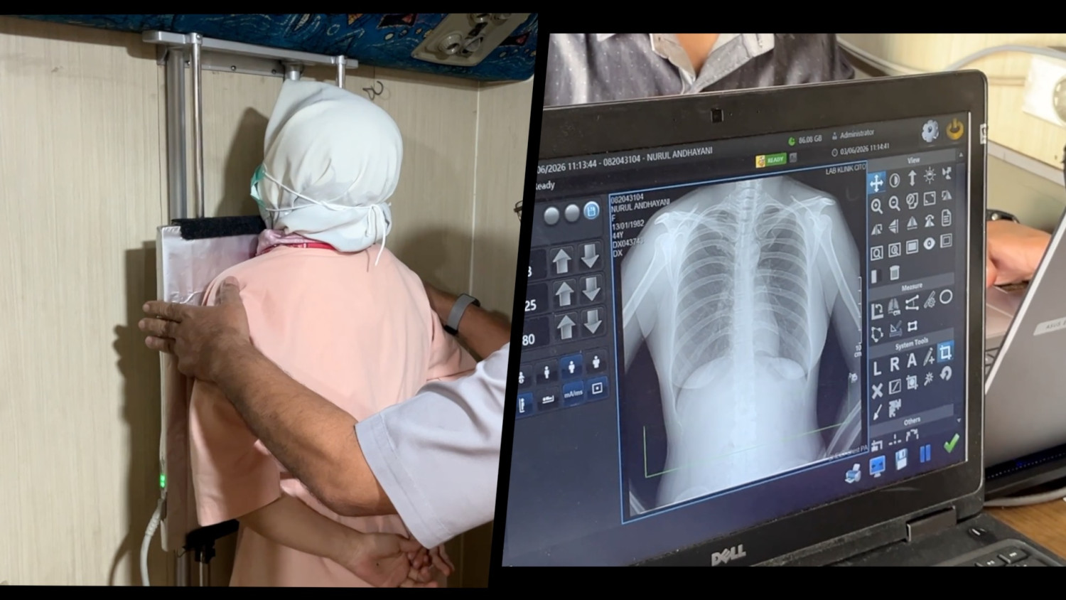 Tekan penyebaran TBC, Dinkes Kota Malang gencarkan screening mobile ...